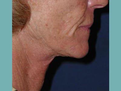 Titan Skin Tightening Before and After Pictures | McRae MD Medical ...