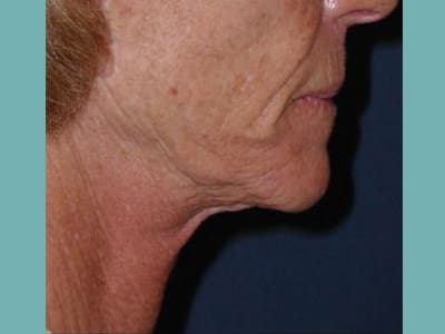 Titan Skin Tightening Before and After Pictures | McRae MD Medical ...